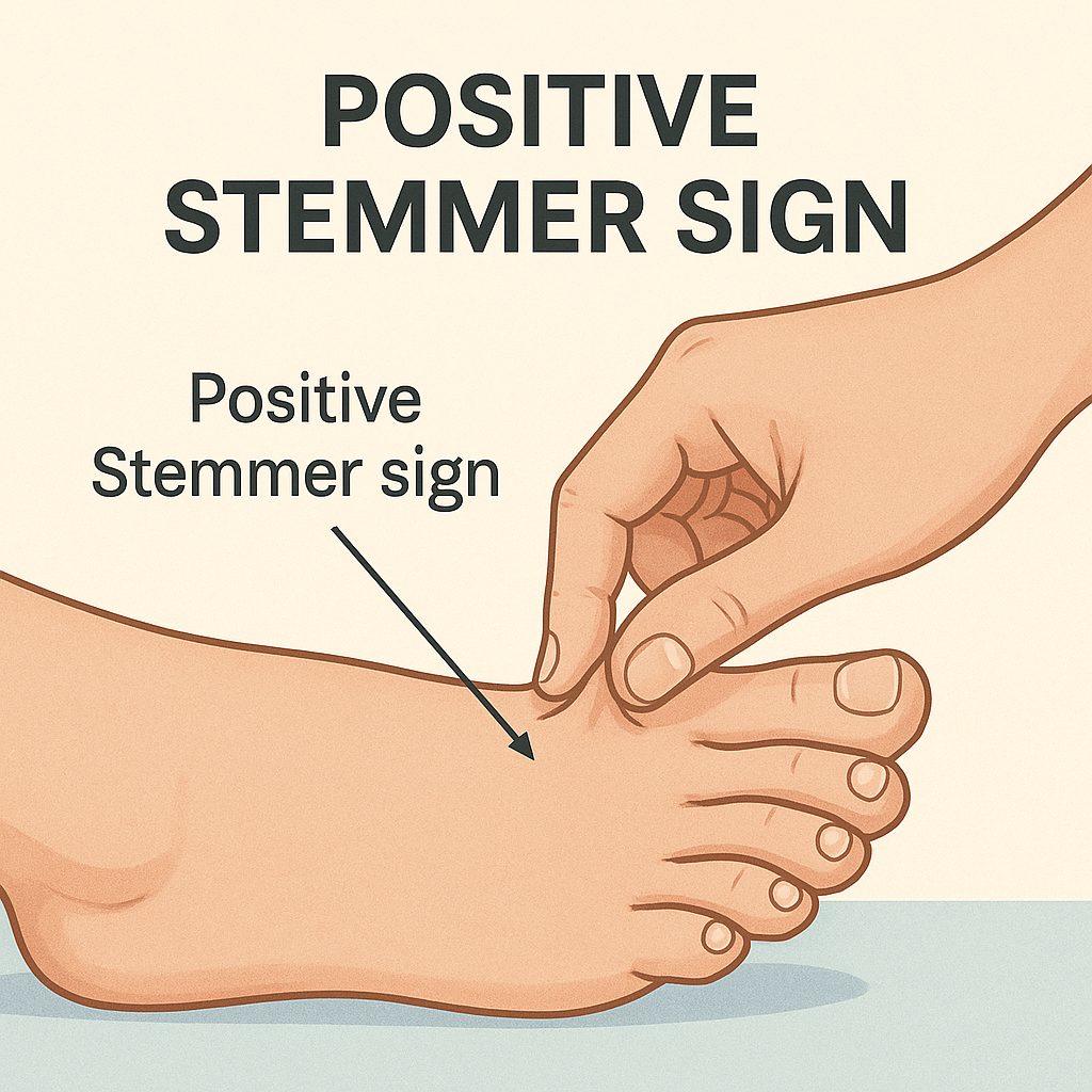 Pitting Edema vs. Lymphedema: How to Tell Them Apart (and Why It ...